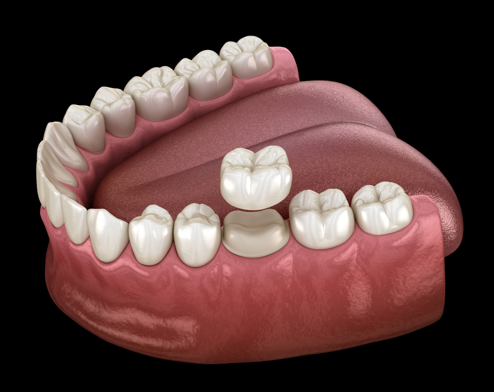Crowns & Bridges - Holistic Dental Center
